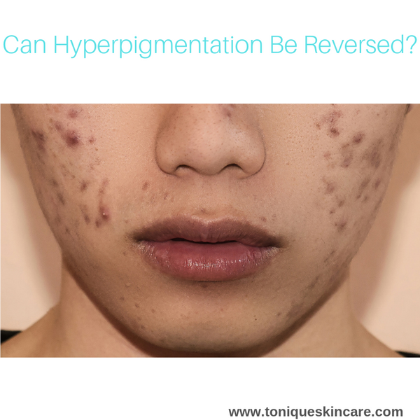 Can hyperpigmentation be reversed? - Tonique Skincare