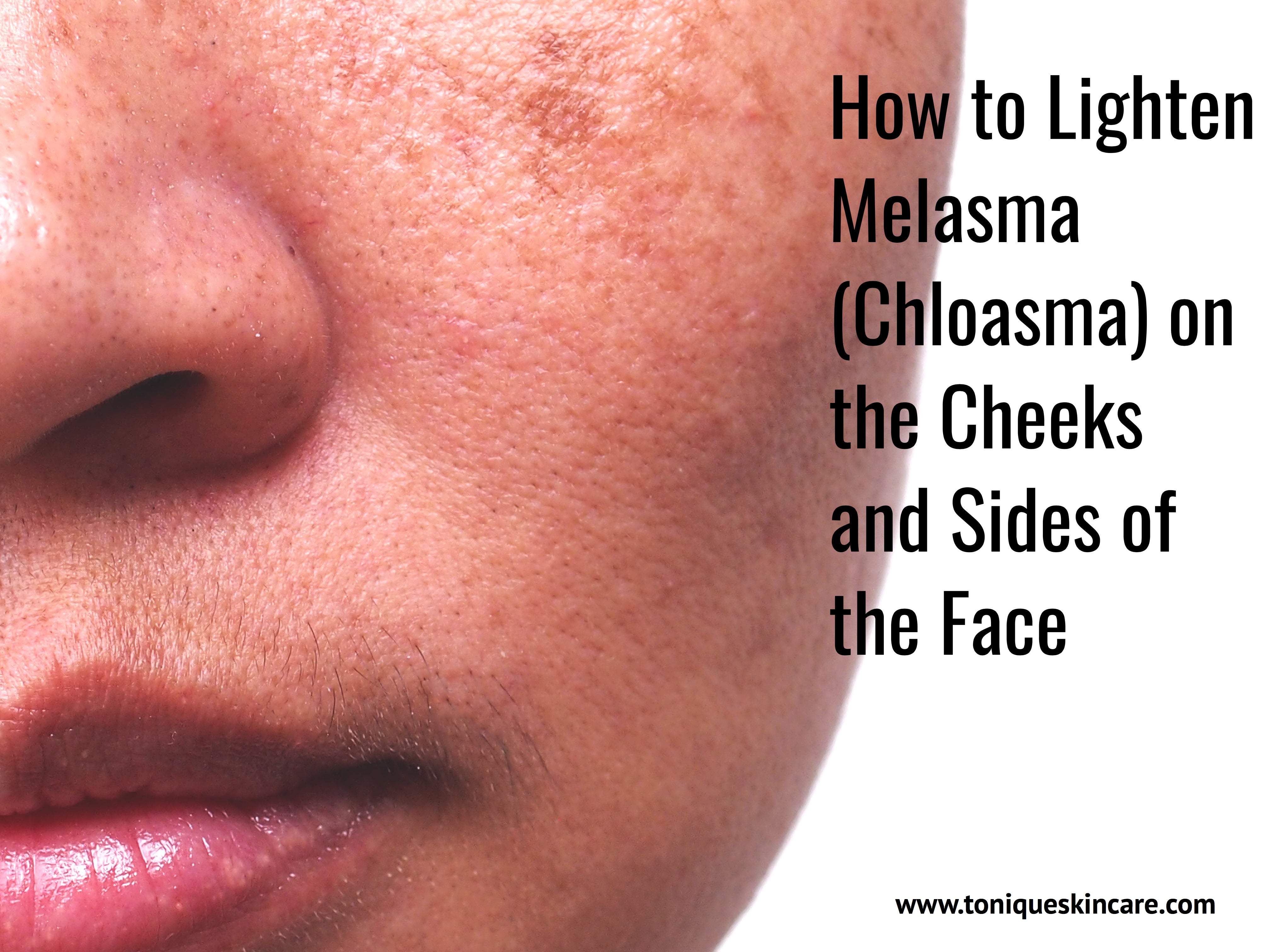 How to Lighten Melasma (Chloasma) on the Cheeks and Sides of the Face
