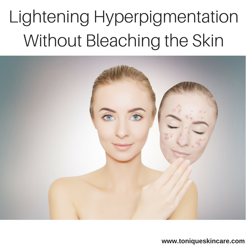 Lightening Hyperpigmentation Without Bleaching the Skin