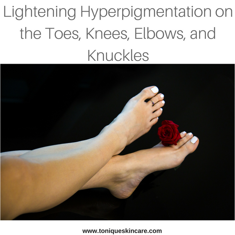 Lightening Hyperpigmentation on the Toes, Knees, Elbows, and Knuckles